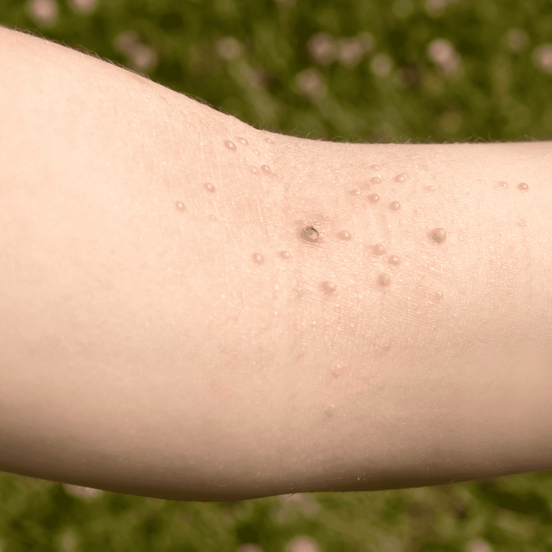 Natural Treatment For Molluscum Contagiosum - Dr. Green Mom