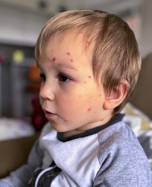 Viral Exanthem Rashes In Children - Dr. Green Mom
