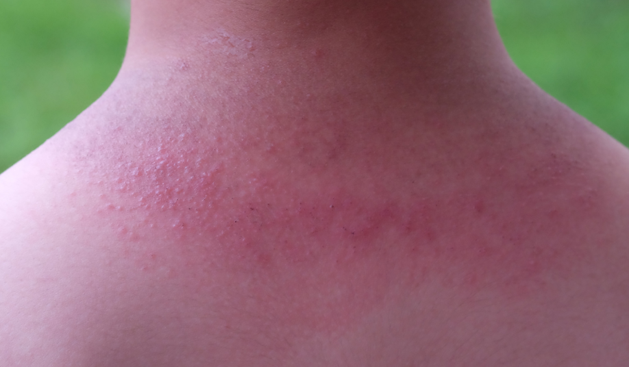 Viral Exanthem Rashes In Children - Dr. Green Mom