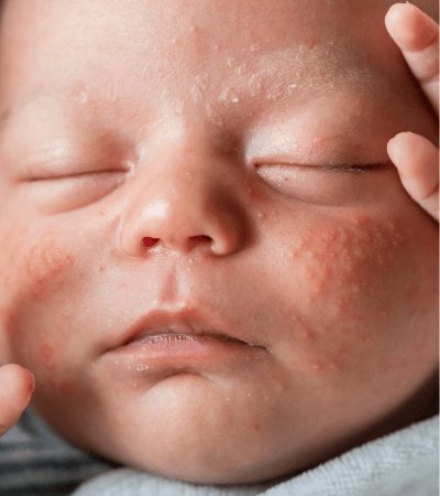 8 Common Infant Skin Conditions - Dr. Green Mom
