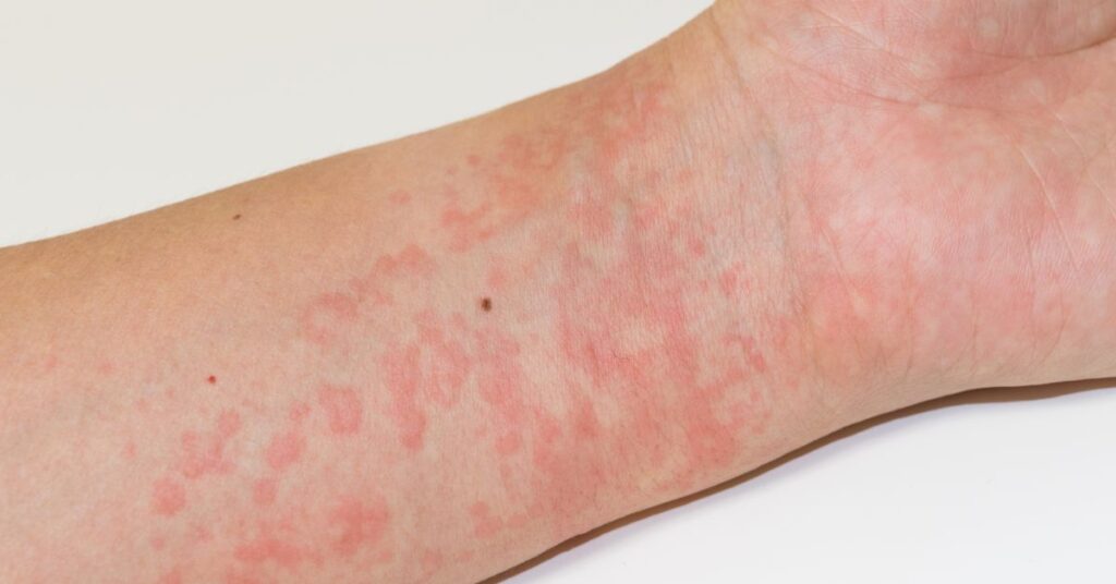 Understanding Hives in Children - Dr. Green Mom