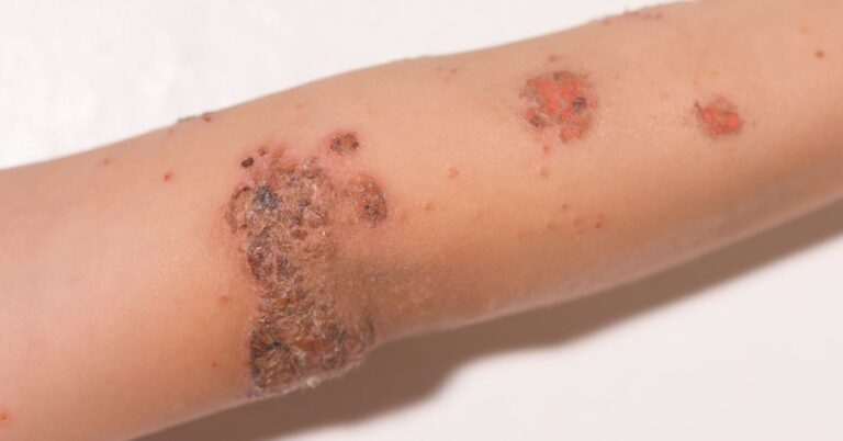 All About Impetigo - Dr. Green Mom