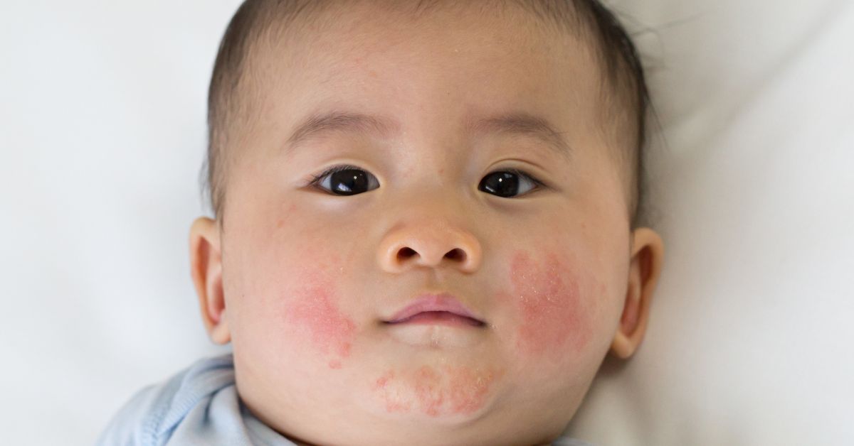 Drool Rash in Babies and Toddlers: A Guide for Parents - Dr. Green Mom