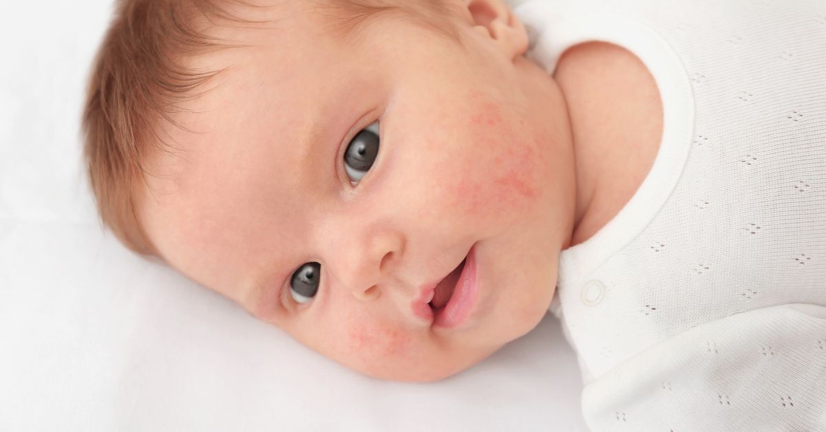 Drool Rash in Babies and Toddlers: A Guide for Parents - Dr. Green Mom